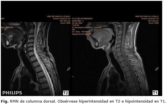 Mielitis transversa secundaria a neurosífilis en un paciente portador ...