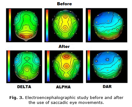 Evolución clínica y electroencefalográfica en pacientes con infarto ...