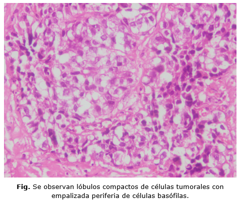 Carcinoma tímico basaloide / Basaloid thymic carcinoma | Pérez Montes ...