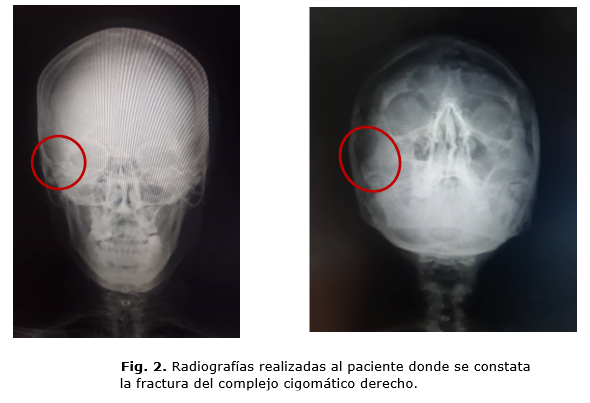 Tratamiento de fractura del complejo cigomático de grado III ...