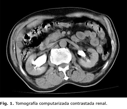 Forma infrecuente en la detección del cáncer prostático / A rare form ...