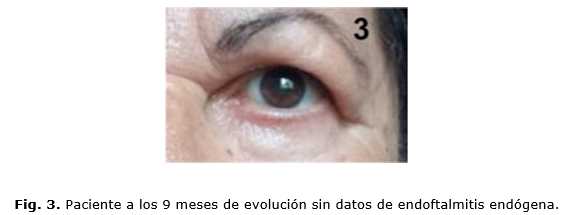 Endoftalmitis endógena con evolución hacia panoftalmitis / Endogenous ...